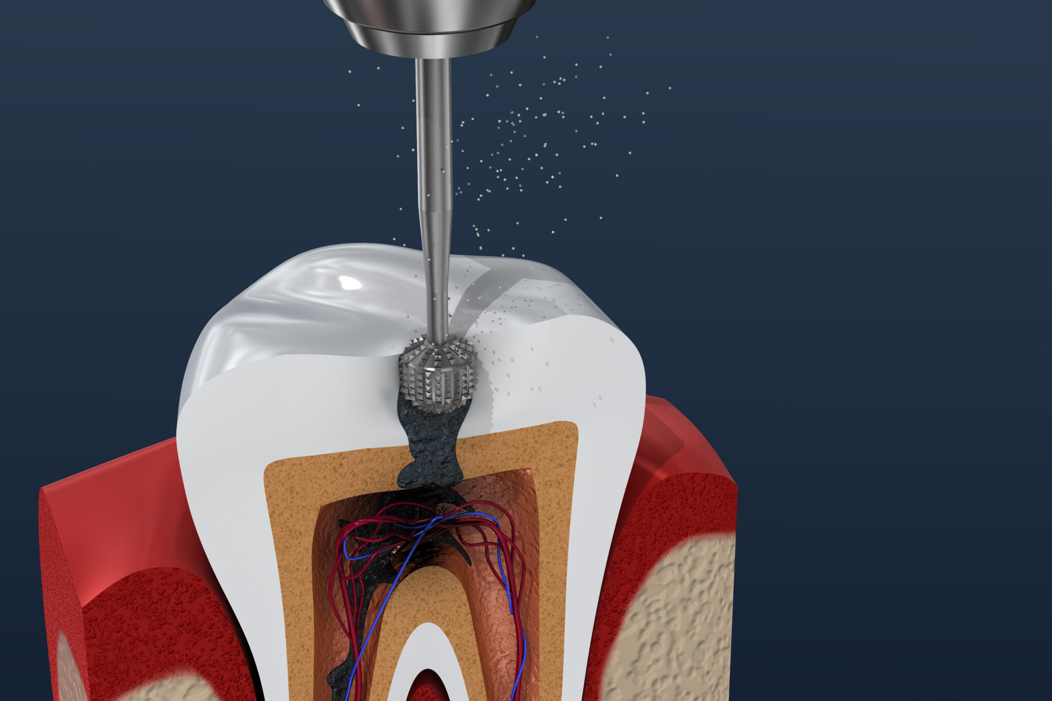 Understanding Different Types of Root Canals - Cascade Endodontics